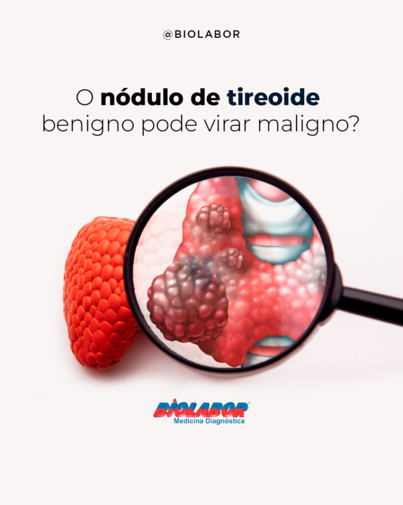 O nódulo de tireoide benigno pode virar maligno? - Biolabor Medicina ...